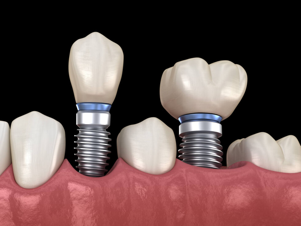 Dental Implant Abutment Explaination